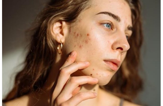 Acne | Anbos